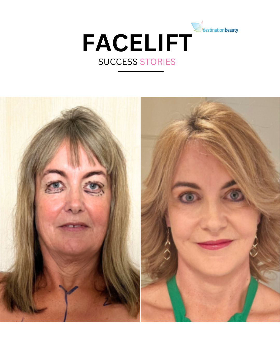 Facelift Success Stories - Destination Beauty