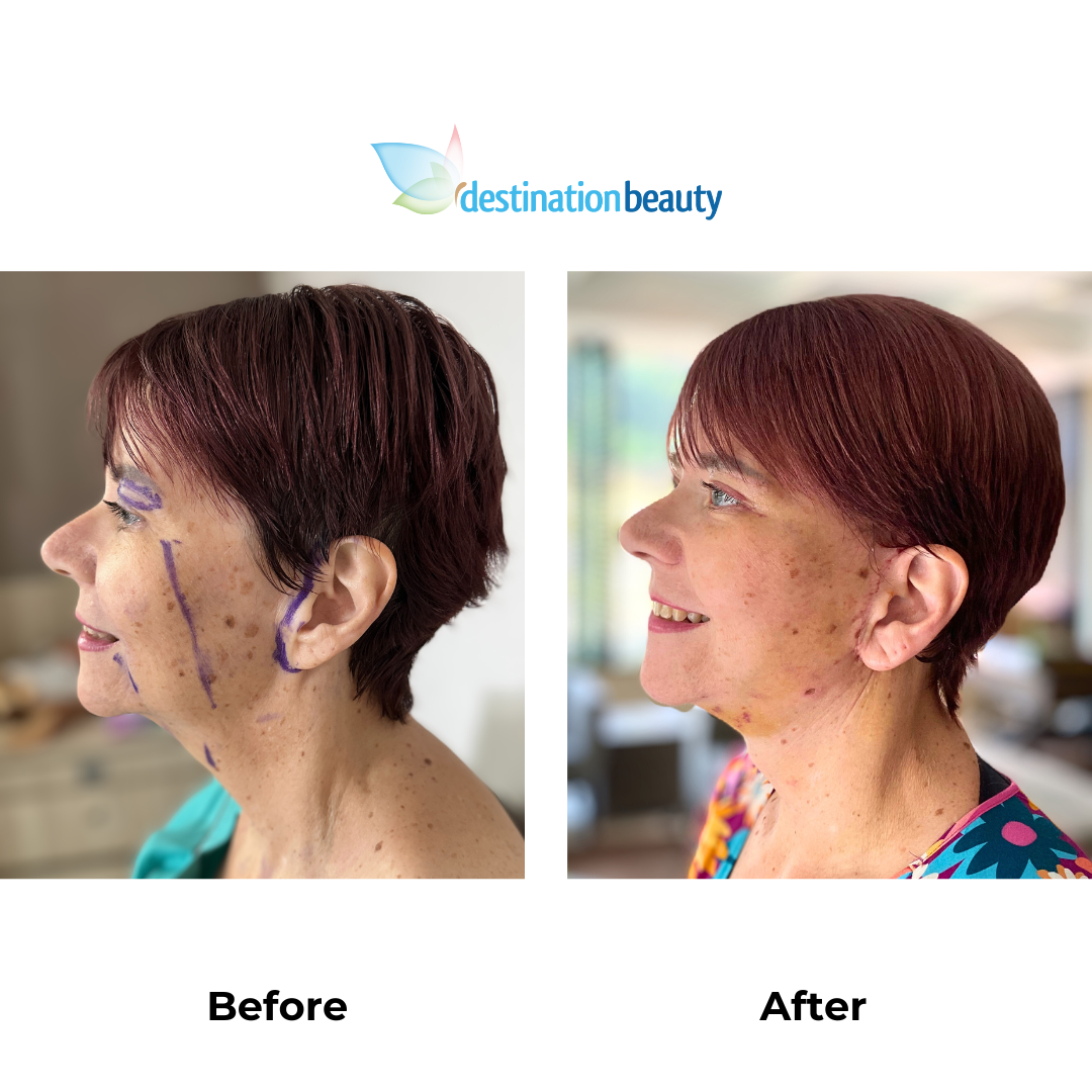 Tania had facelift surgery in Thailand - Destination Beauty
